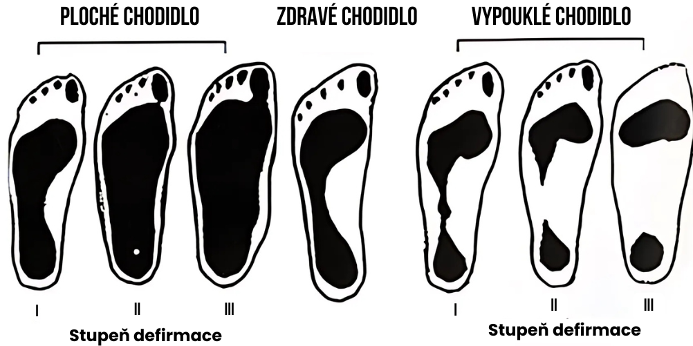 Ploché nohy: jak je odhalit doma a jak vybrat správné vložky pro ...